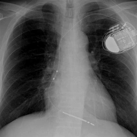 Common Causes Of Implantable Cardioverter Defibrillator Shocks