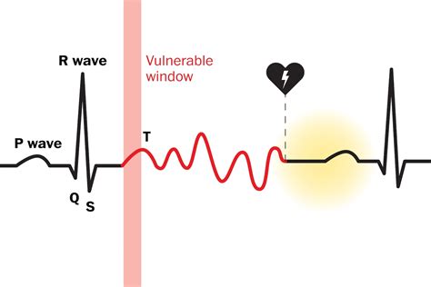 Commotio Cordis Triggers Cardiac Arrest In Athletes But Risks Can Be
