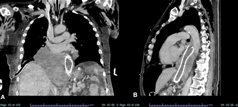 Esophageal Perforation Secondary To Esophageal Gastrointestinal Stromal