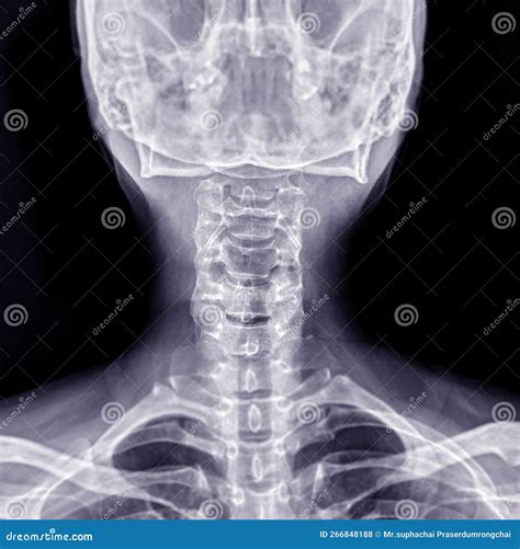 Xray Cspine Ou Xray Image Of Cervical Spine Ap View For Diagnostical Intervertebral Disk Hernie