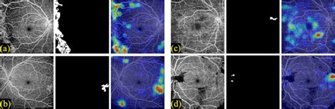 Localization Result Of Dr Grading Model For Pdr Samples Including Nv Download Scientific