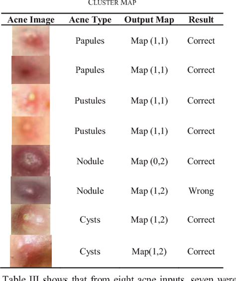 Figure 1 From Acne Segmentation And Classification Using Region Growing