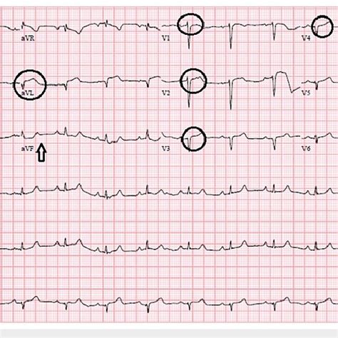 St Segment Elevations In 1 Avl V1 V2 V3 And V4 As Shown By