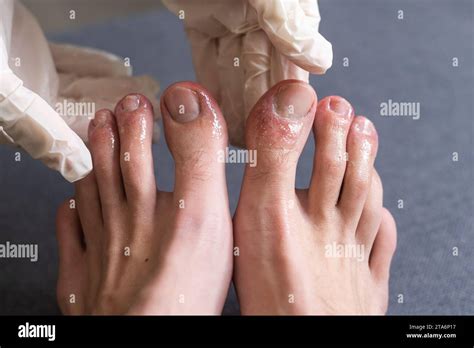 A Mans Toes Showing What Looks Like A Rash With Red Blotchy Skin A