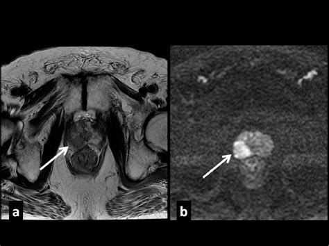 Figure 1 From Trans Rectal Ultrasound Trus Guided Biopsy With Mri