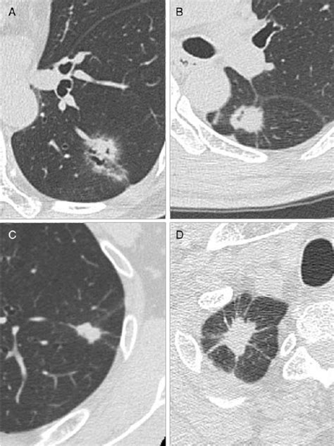 A A 58 Year Old Female Had A 28 Cm Part Solid Nodule In The Left Download Scientific