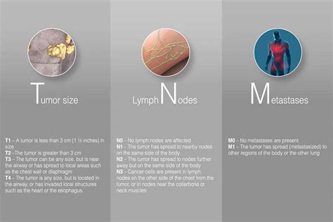 What Are The Stages Of Prostate Cancer Prostate Cancer Foundation Of Chicago