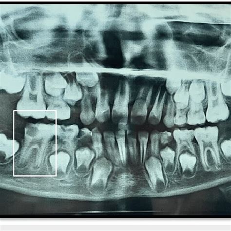Pre Operative Radiograph Orthopantogram Opg Shows Incomplete Root