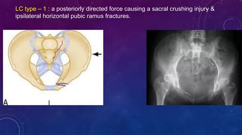 Pelvic Injuries And Associated Injuries Pptx