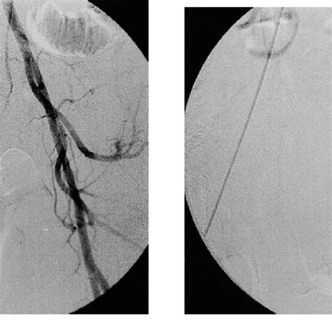 A Pelvic Angiogram Demonstrating Enlarged Right Uterine Artery