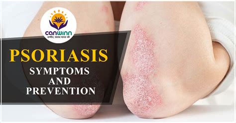 Psoriasis Symptoms And Preventions Canwinn Foundation Canwinn