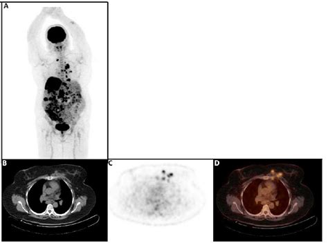 47 Year Old Female Patient With Multiple Liver Metastasis And Abominal