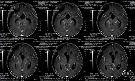 儿童颅咽管瘤的手术治疗 脑医汇