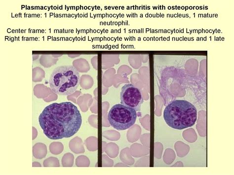 Plasma Cell Vs Lymphocyte