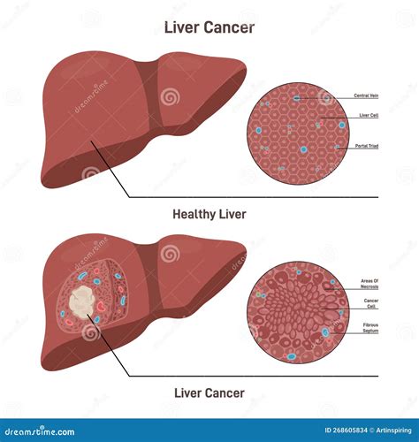 Liver Cancer Comparison Between Healthy Organ And Liver With Carcinoma Stock Vector