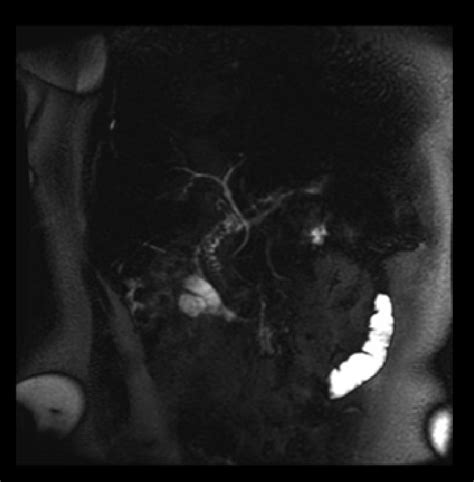 Magnetic Resonance Cholangiopancreatography Download Scientific Diagram