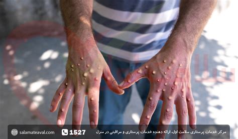 آبله میمون چیست علائم و درمان ابله میمونی عکس