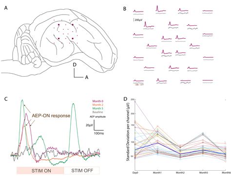 Subdural Soft Electrocorticography Ecog Array Implantation And Long