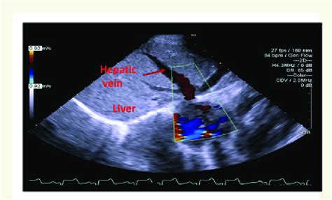 Subcostal Image Demonstrating Flow From Tricuspid Regurgitation