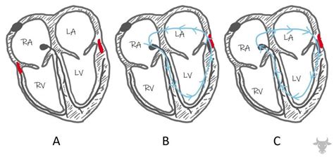 Atrioventricular Reentrant Tachycardia Ecg Stampede
