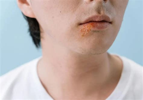 Cold Sores Treatment In Delhi Get Clear Skin Now