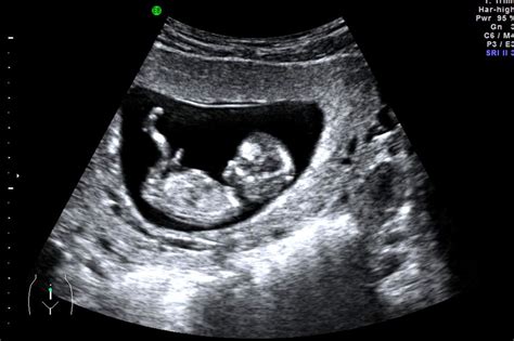 12 Week Pregnancy Dating Scan Nhs