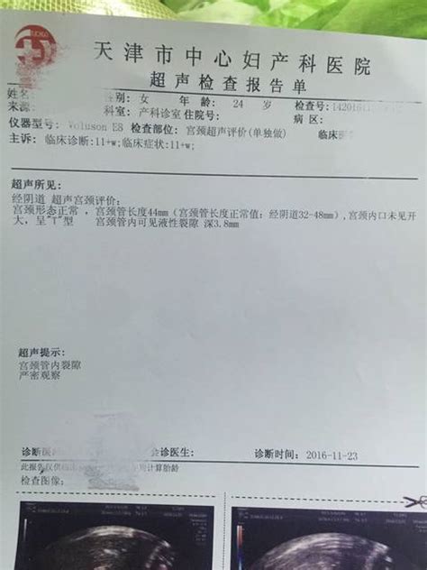宫颈口有小硬疙瘩图片 宫颈口长息肉的图片 随意云
