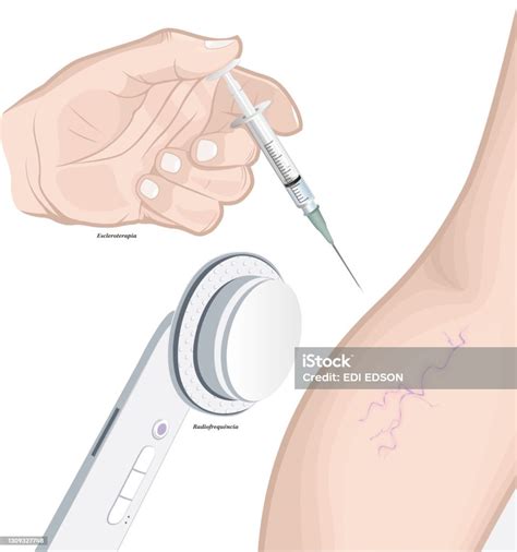 경화요법 또는 응용은 현장에서 직접 물질의 적용으로부터 정맥을 제거하거나 감소시키기 위한 치료법입니다 하지정맥류에 대한 스톡