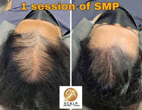 Scalp Micropigmentation Before And After Examples Scalp Amplified