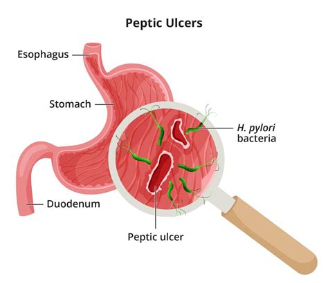 Gastric Ulcer