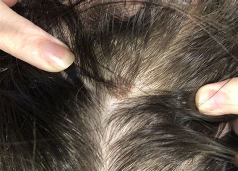 Signs Of Skin Cancer Scalp At Rosemarie Leeann Blog