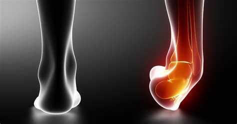 Achilles Tendon Injuries Ocala Fl Dr Karl Siebuhr Md