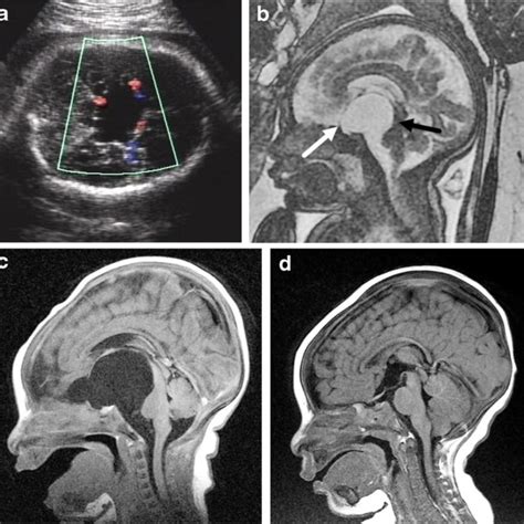 Terminal Myelocystocele And Spinal Cord Syrinx A Sagittal T2 W