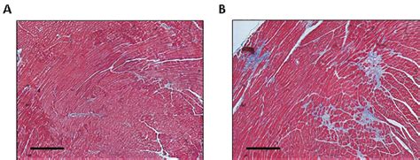 Video Ultrasonic Assessment Of Myocardial Microstructure