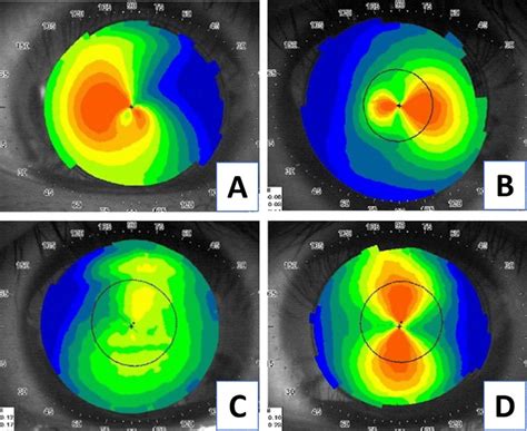 The Example Of The Trained Cnn A And B Are The Keratoconus Group