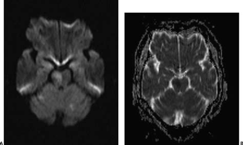 Diffusion Weighted Magnetic Resonance Imaging MRI A And Apparent Download Scientific