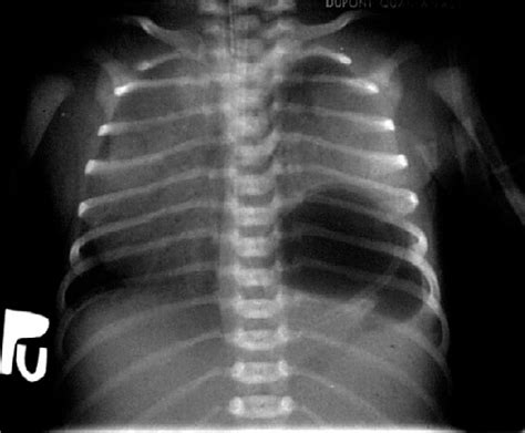 Chest Radiograph Showed Left Diaphragmatic Hernia Download Scientific