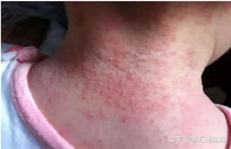 夏天孩子长痱子怎么办？ 知乎