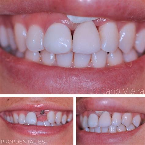 Dientes provisionales la solución temporal para lucir tu mejor sonrisa