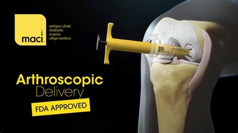 Maci Arthro Instrumentation An Exciting Development In Arthroscopic Knee Cartilage Repair