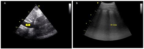 Echocardiographic Markers Of Congestion A Increased Ivc Inferior