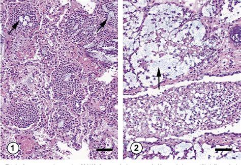 Bronchial Epithelial Hyperplasia Semantic Scholar