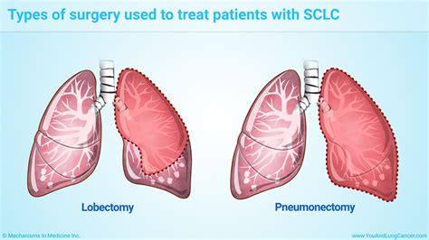 Slide Show Treatment And Management Of Small Cell Lung Cancer Sclc