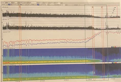 Quabtitative Eeg Diagram Quizlet