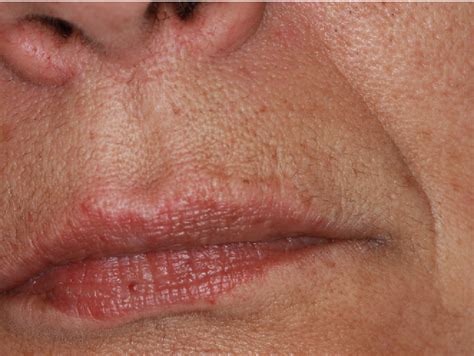 Figure 1 From Keratoacanthoma In The Cutaneous Area Of The Upper Lip A