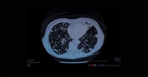 Bronchiectasis Mind The Bleep