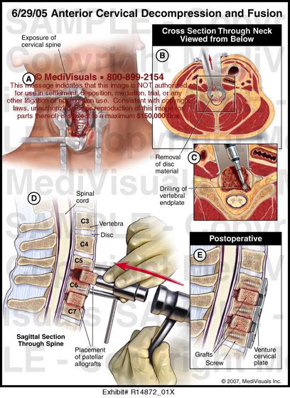 Anterior Cervical Decompression And Fusion Medivisuals