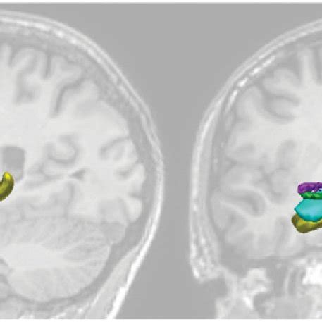 Three Dimensional Relationship Of The Right Piriform Cortex On The