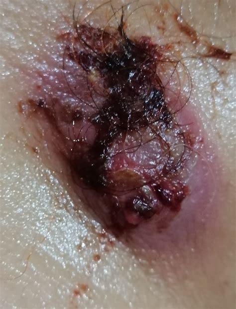 Ask A Endocrinologist Online For Exploded Lymph Node