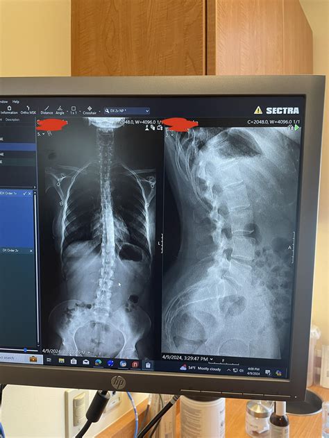 Xrayporn